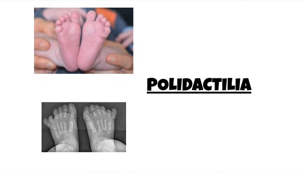 polidactilia pedopediatria | Genially