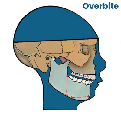 Jaw Surgery Anatomy