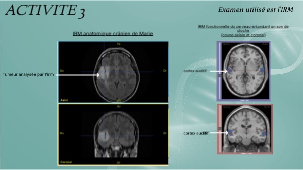 svt-Marie-IRM | Genially