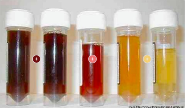 Haematuria types