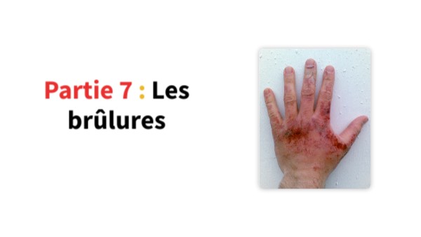 PSC - Partie 7 - brulures | Genially