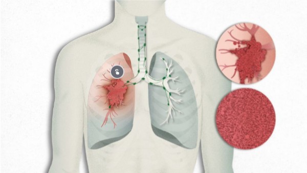 Cancer de Pulmo | Genially