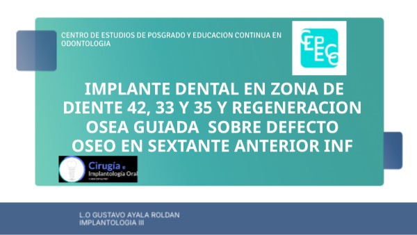 implante dental en zona de diente 42, 33 y 35 y regeneracion osea ...