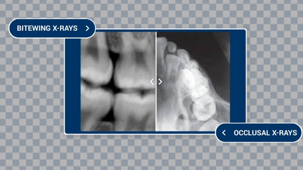 Bitewing Vs Occlusal X-Rays | Genially